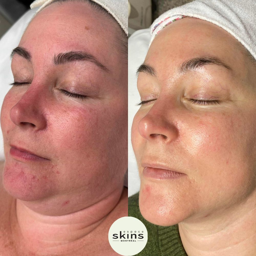 Comment Traiter la Rosacée : Étude de Cas Skins Montréal – Espace Skins ...