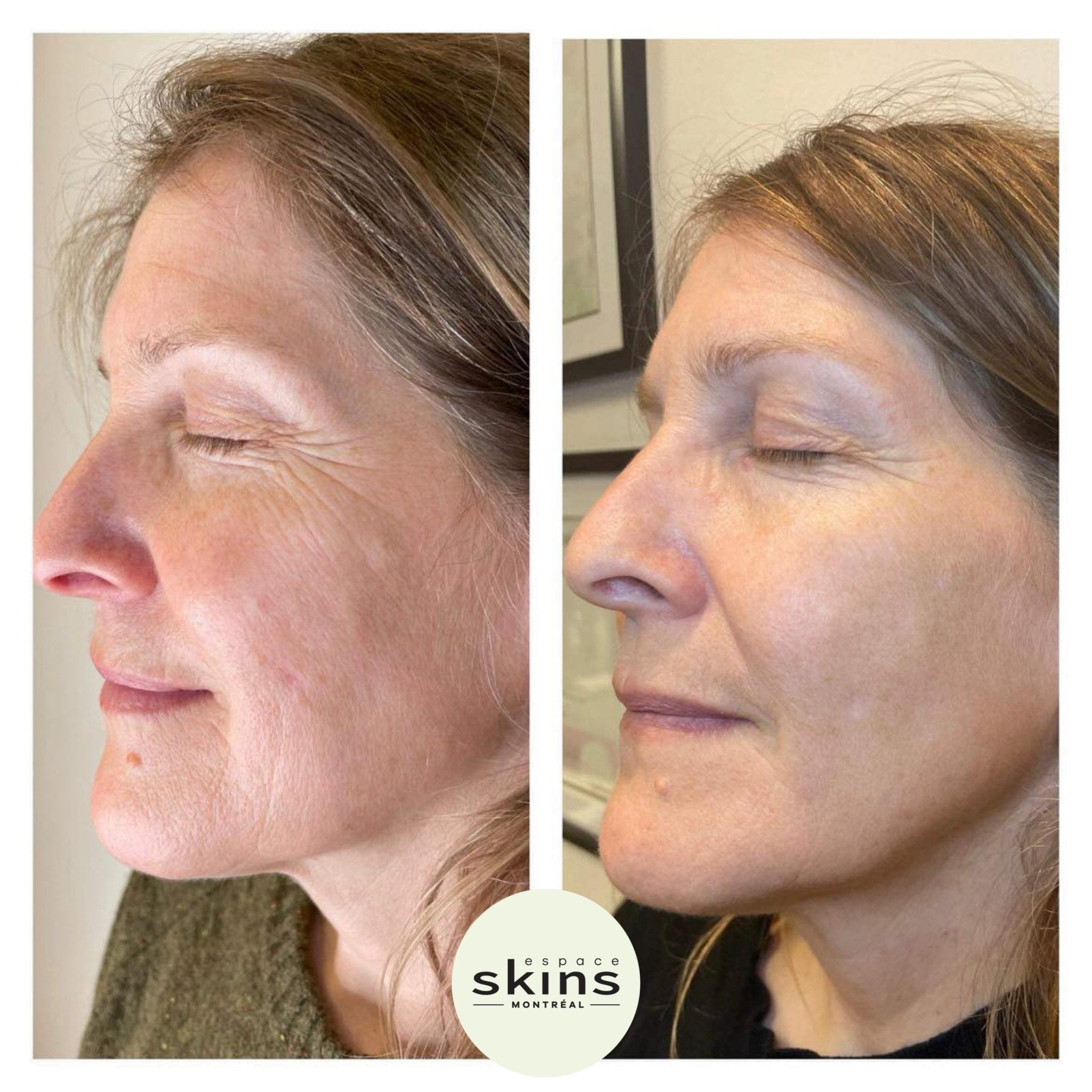 Venus Freeze Facial Montreal | Skin Tightening & Rejuvenation – Espace ...